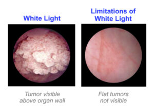 Bladder Cancer: Blue light cystoscopy - Imagin Medical